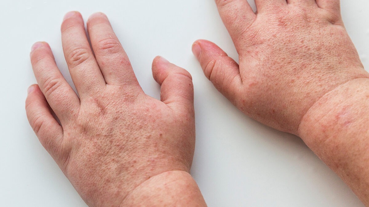 Spálová angína_nikol | MUDr. Michala Knězková - comamdelat.com